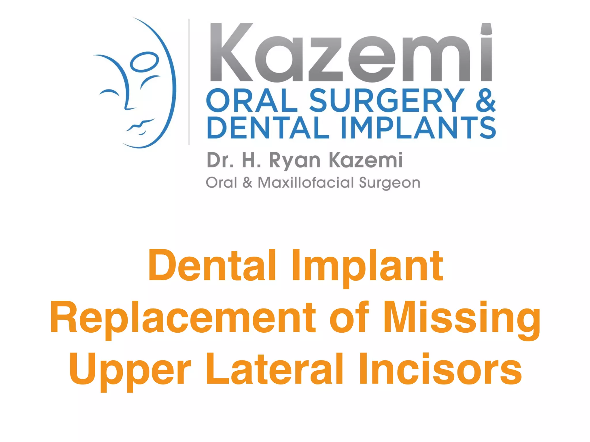 Dental Implants for replacement of Upper Lateral Incisors | PDF