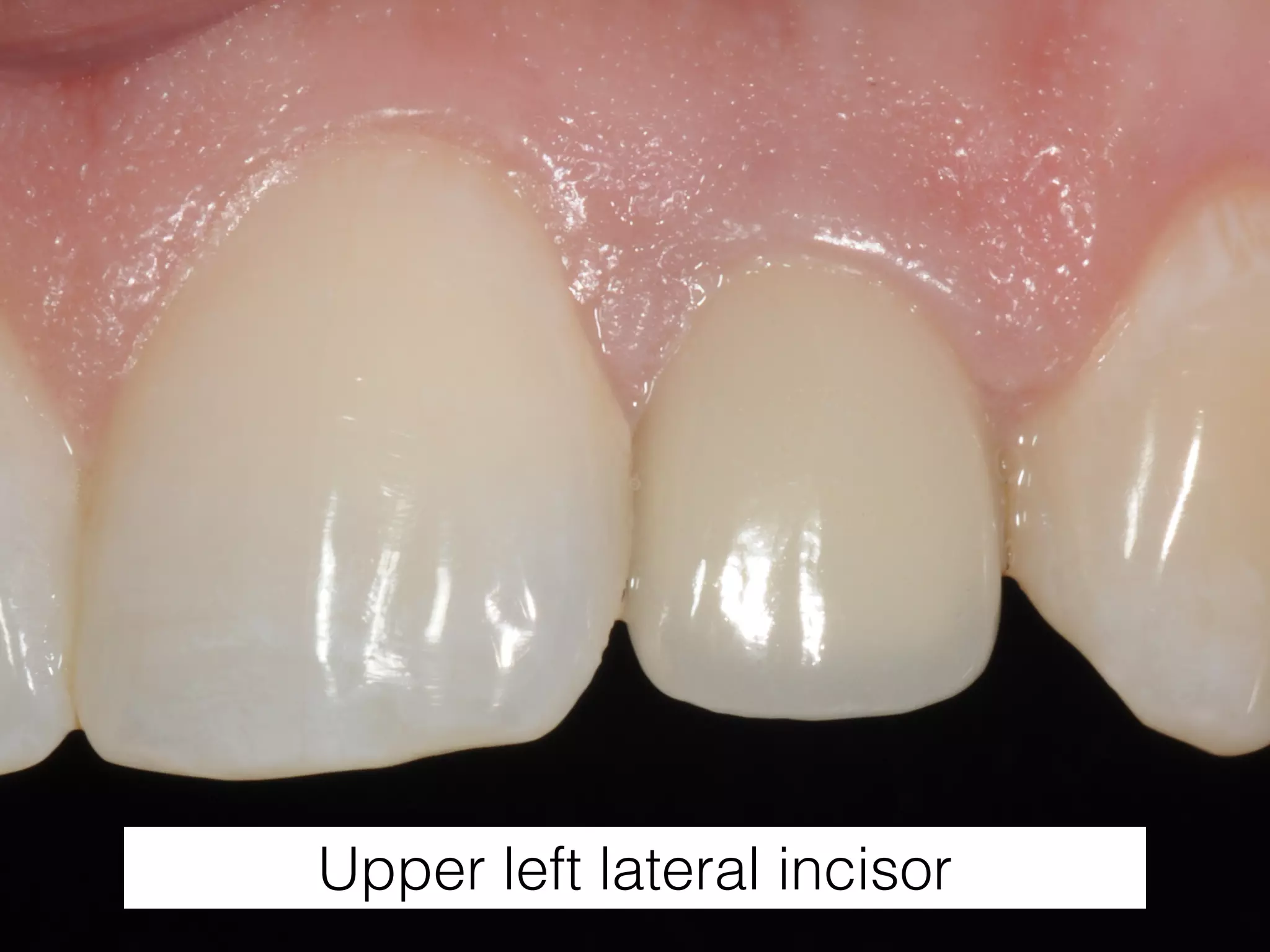 Dental Implants for replacement of Upper Lateral Incisors | PDF