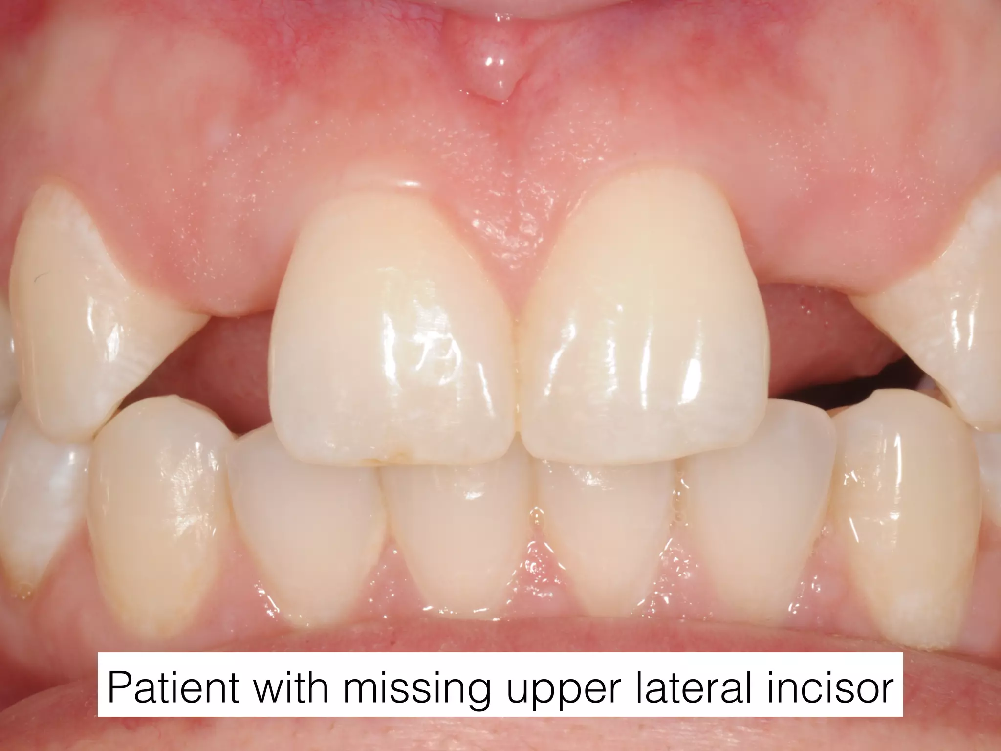 Dental Implants for replacement of Upper Lateral Incisors | PDF