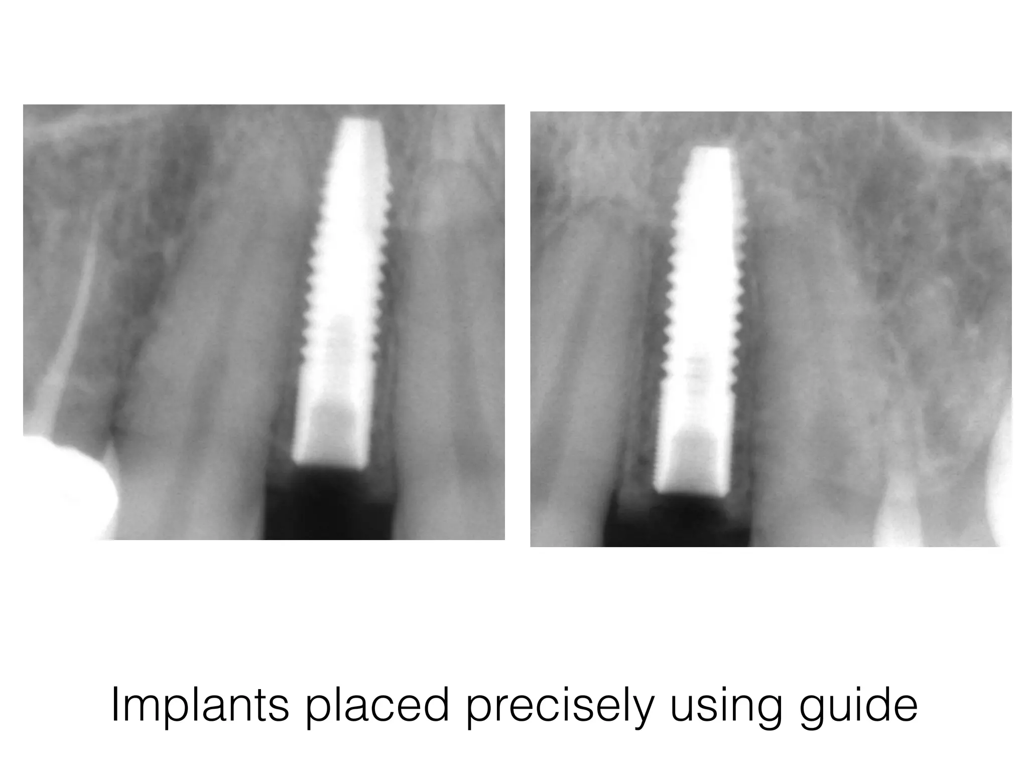 Dental Implants for replacement of Upper Lateral Incisors | PDF