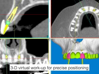 Dental Implants for replacement of Upper Lateral Incisors | PDF