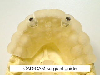 Dental Implants for replacement of Upper Lateral Incisors | PDF