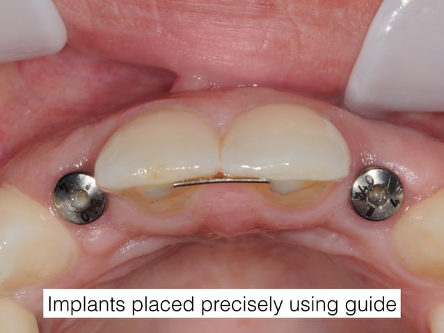 Dental Implants for replacement of Upper Lateral Incisors | PDF