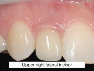Dental Implants for replacement of Upper Lateral Incisors | PPT