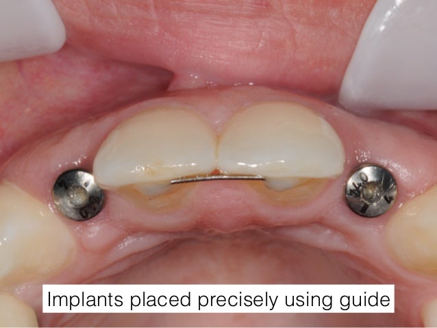 Dental Implants for replacement of Upper Lateral Incisors