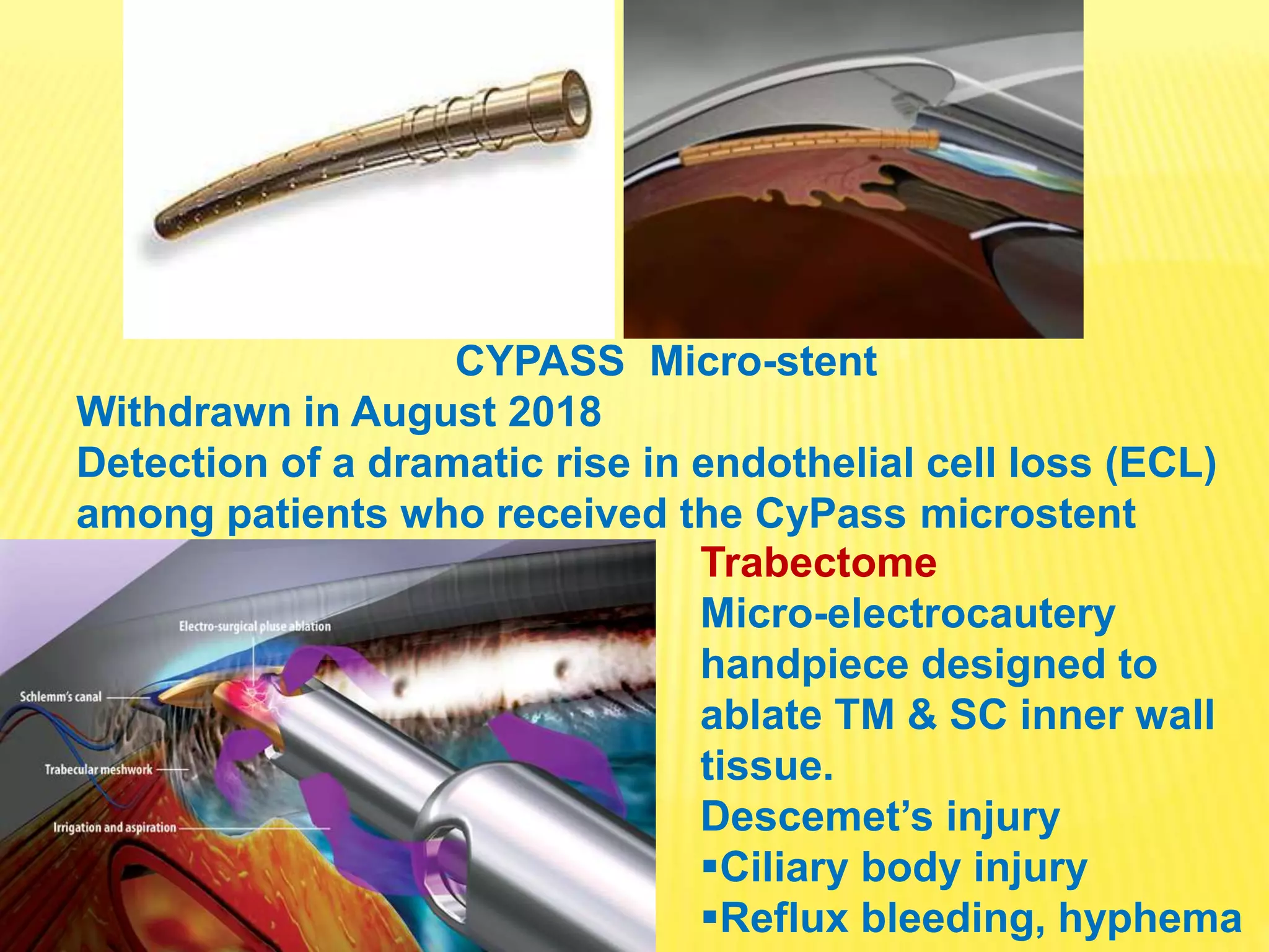 Implants in Ophthalmology | PPTX