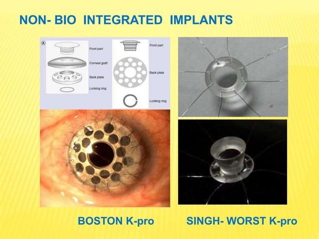Implants in Ophthalmology | PPTX | Eye and Vision Conditions | Diseases ...