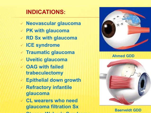 Implants in Ophthalmology | PPTX | Eye and Vision Conditions | Diseases ...