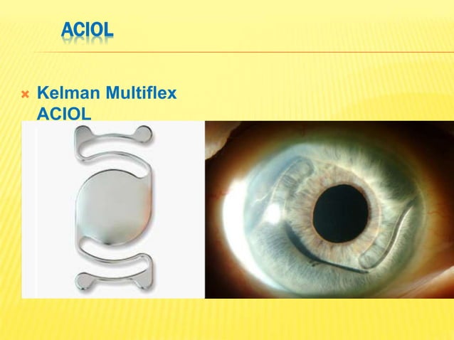 Implants in Ophthalmology | PPTX | Eye and Vision Conditions | Diseases ...
