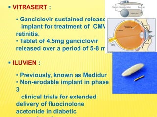Ganciclovir Implant