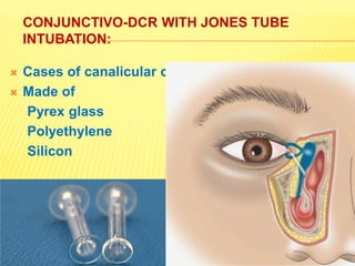 Implants in Ophthalmology | PPT