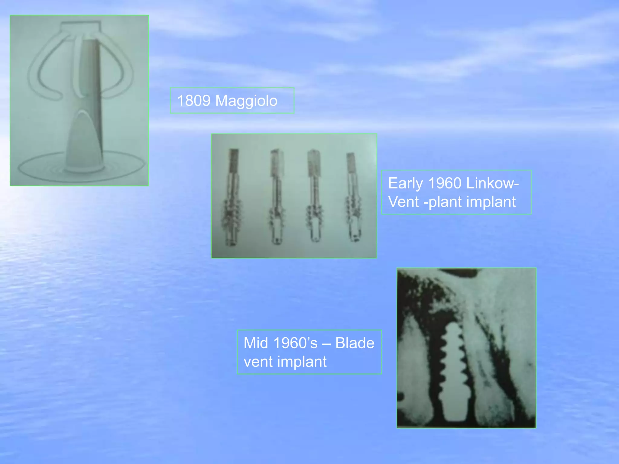 Implants in Orthodontics | PPT