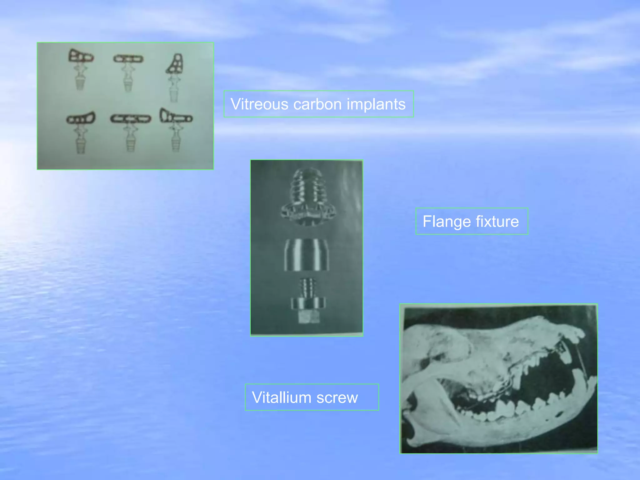 Implants in Orthodontics | PPT