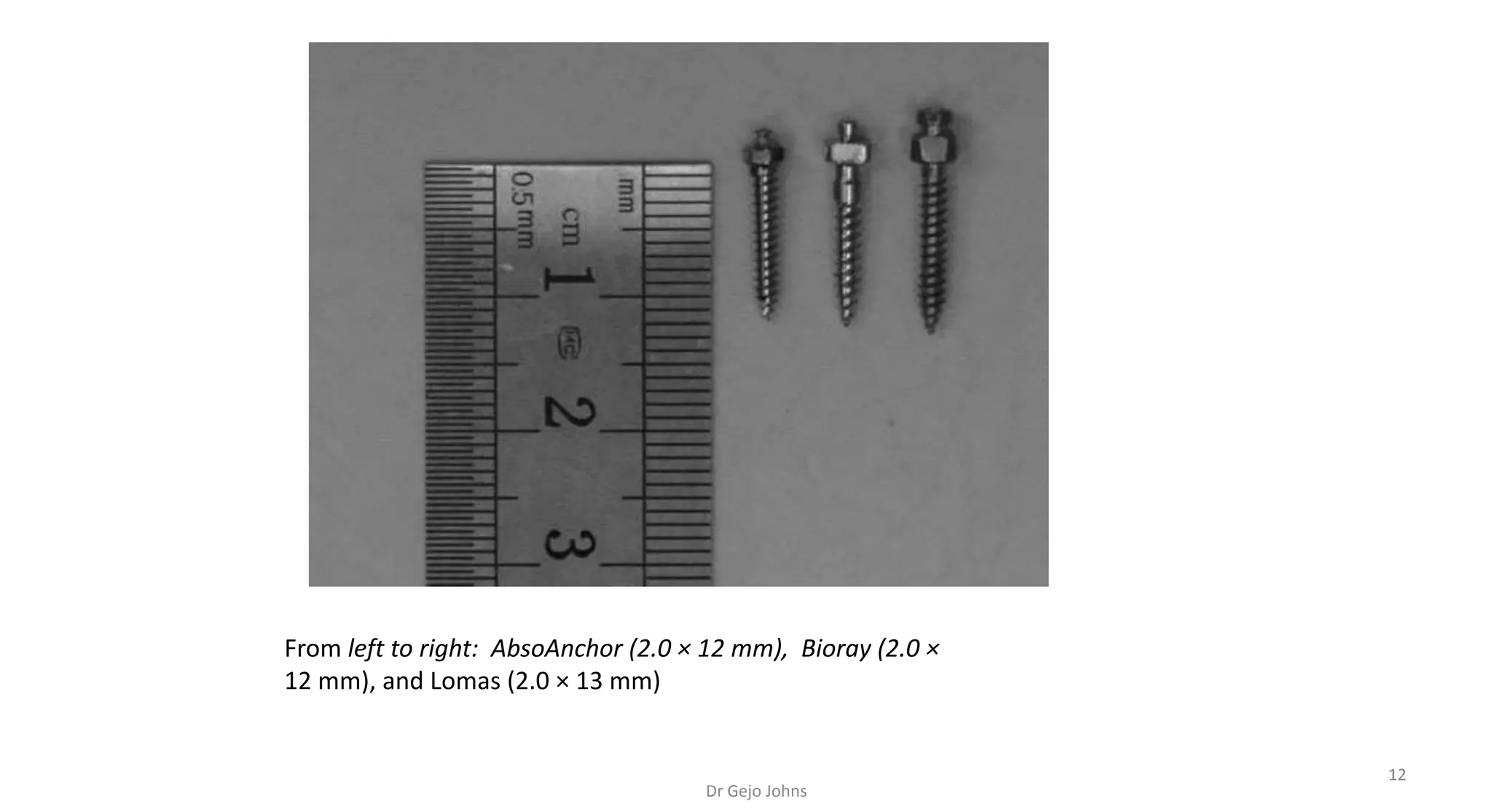 Infra-zygomatic Crest implants (IZC) | PPTX