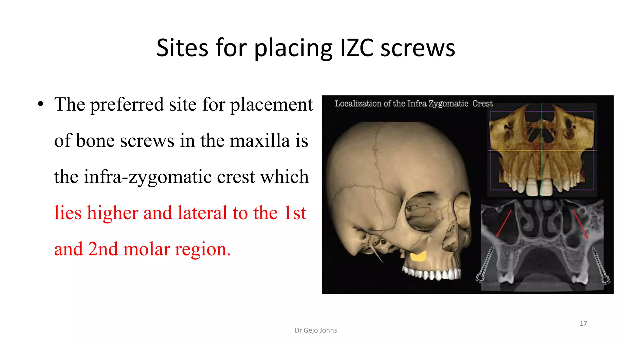 Infra-zygomatic Crest implants (IZC) | PPTX