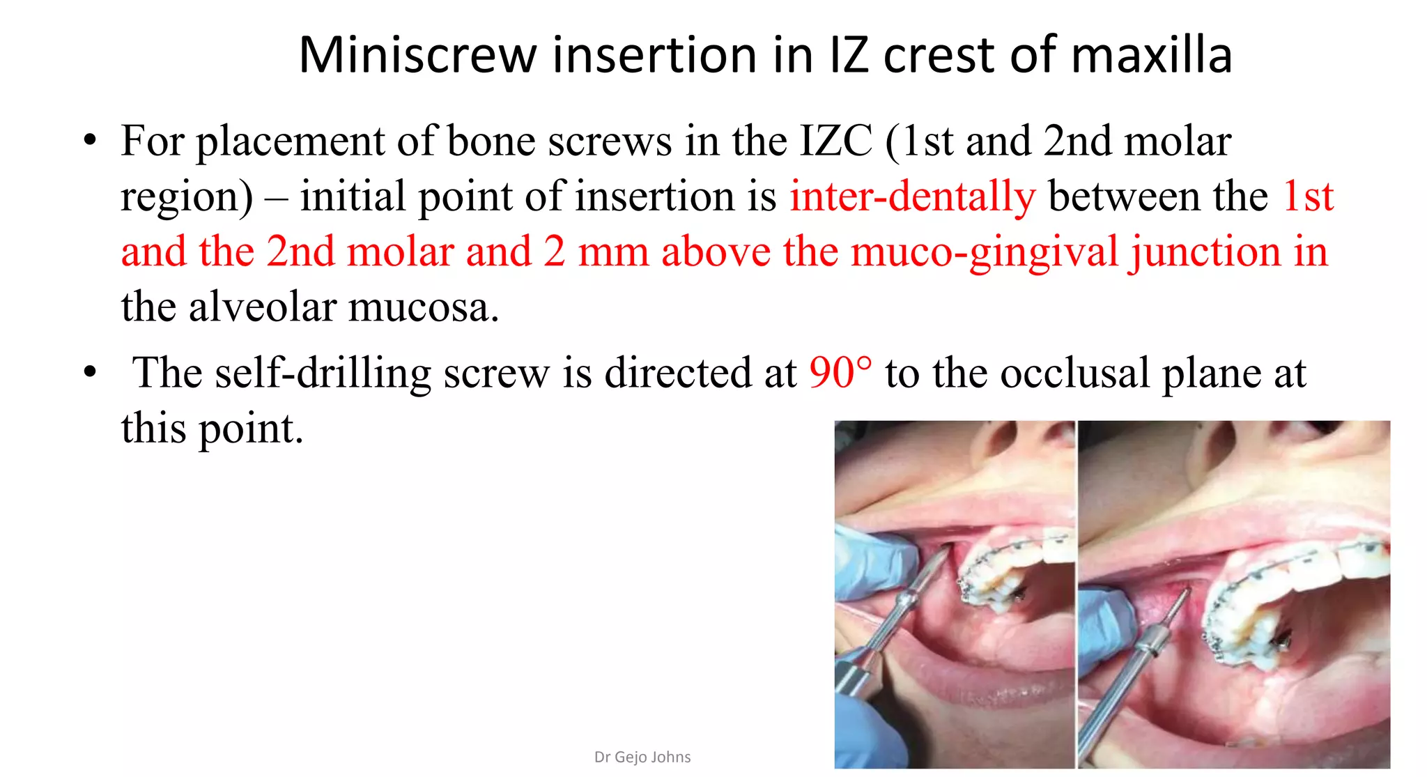 Infra-zygomatic Crest implants (IZC) | PPTX