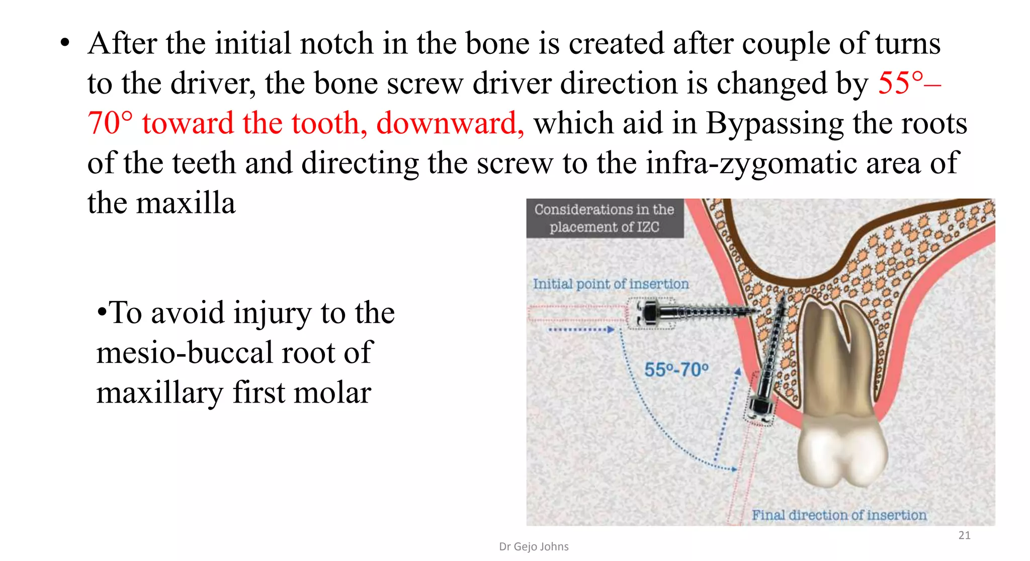 Infra-zygomatic Crest implants (IZC) | PPTX