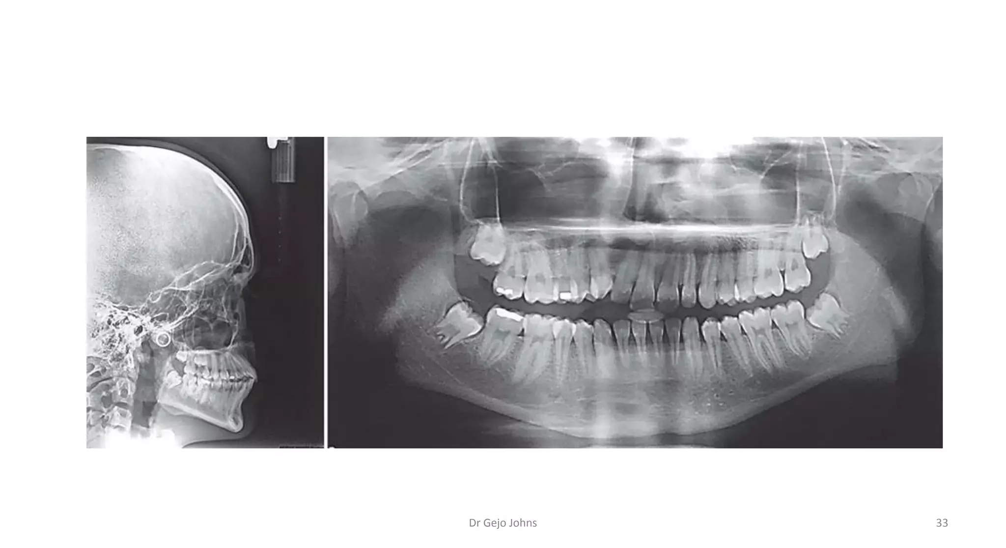 Infra-zygomatic Crest implants (IZC) | PPTX