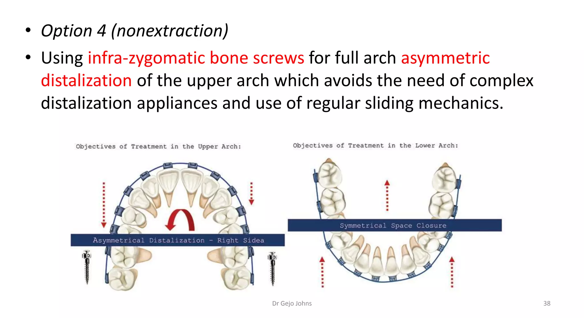Infra-zygomatic Crest implants (IZC) | PPTX