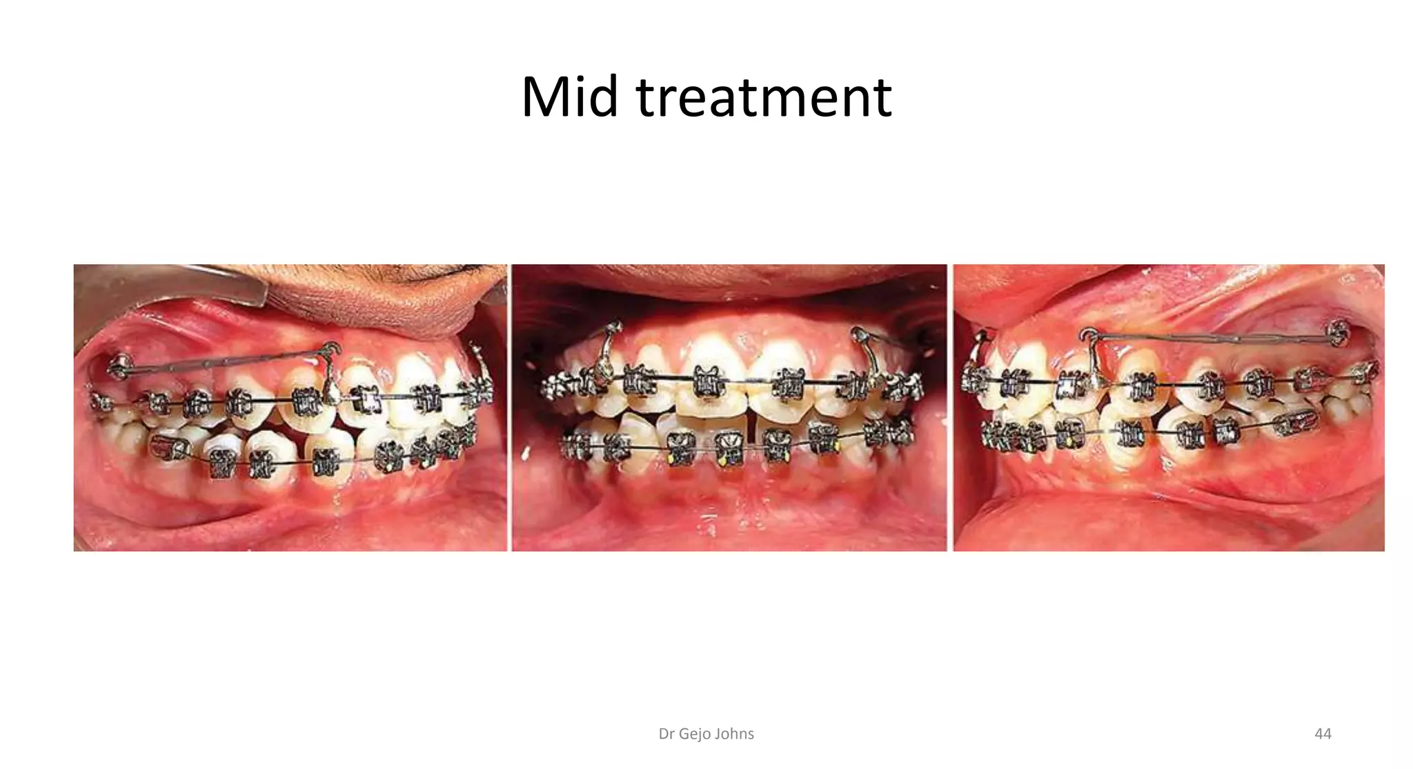 Infra-zygomatic Crest implants (IZC) | PPTX