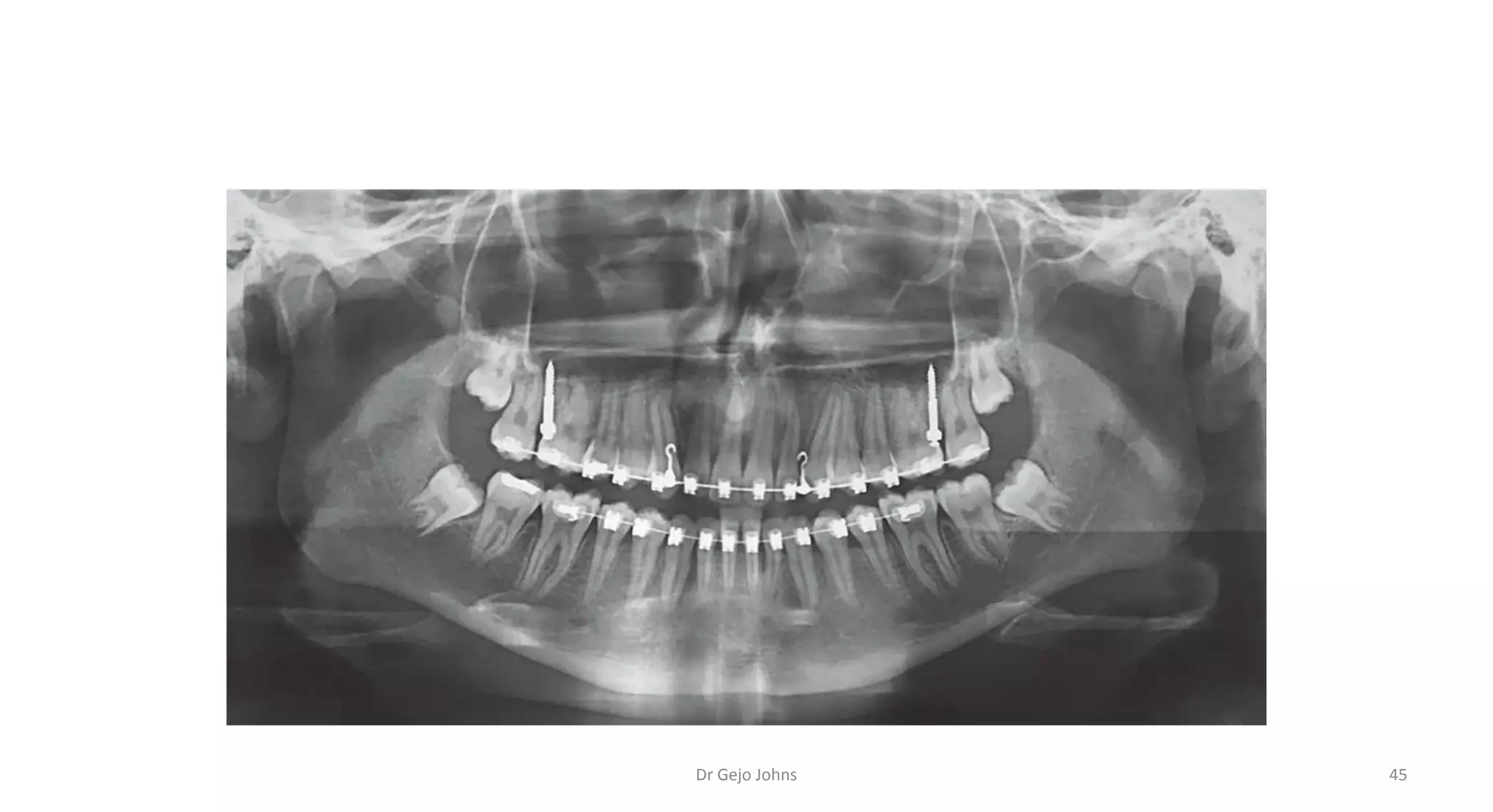 Infra-zygomatic Crest implants (IZC) | PPTX