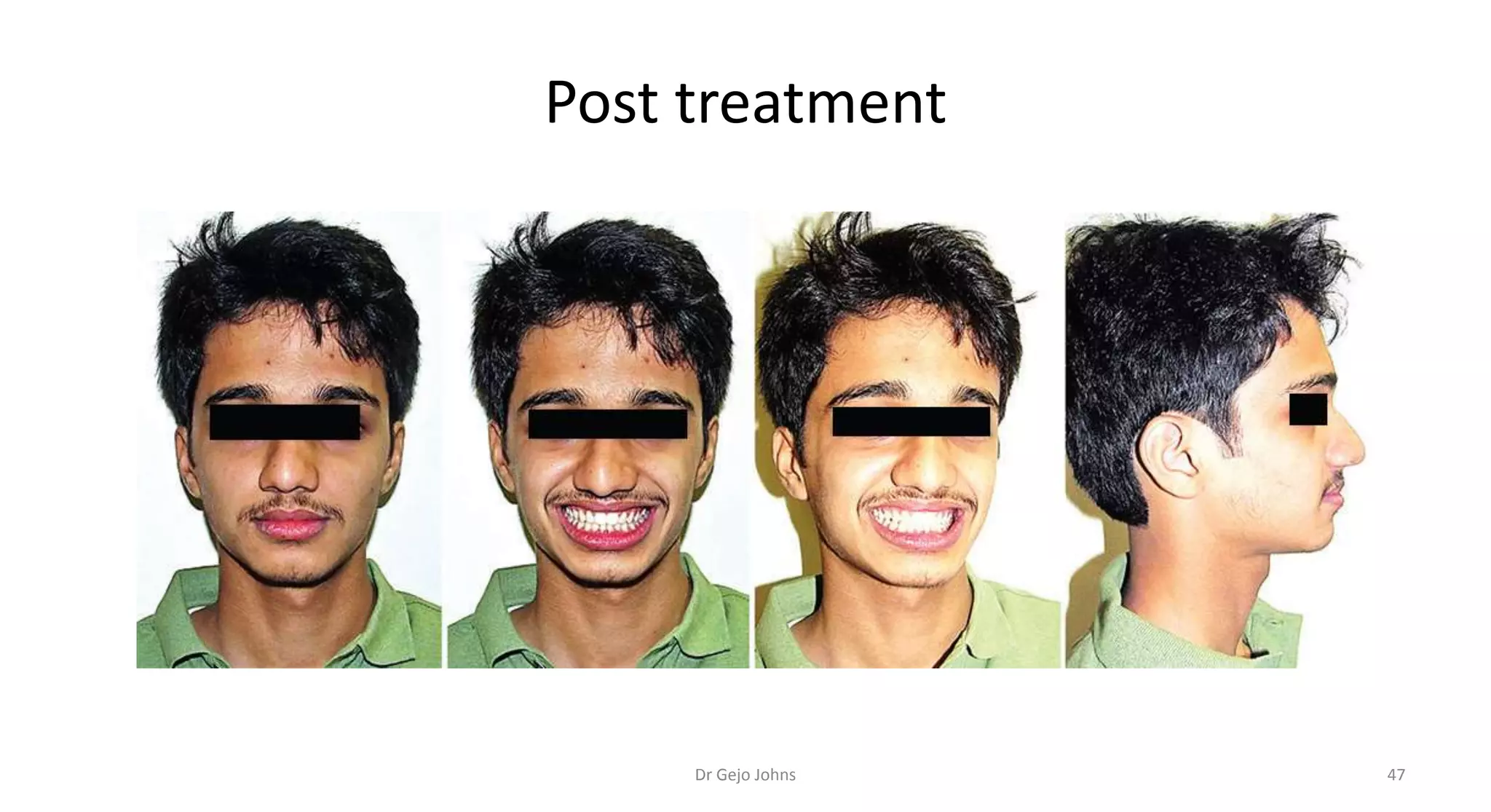 Infra-zygomatic Crest implants (IZC) | PPTX