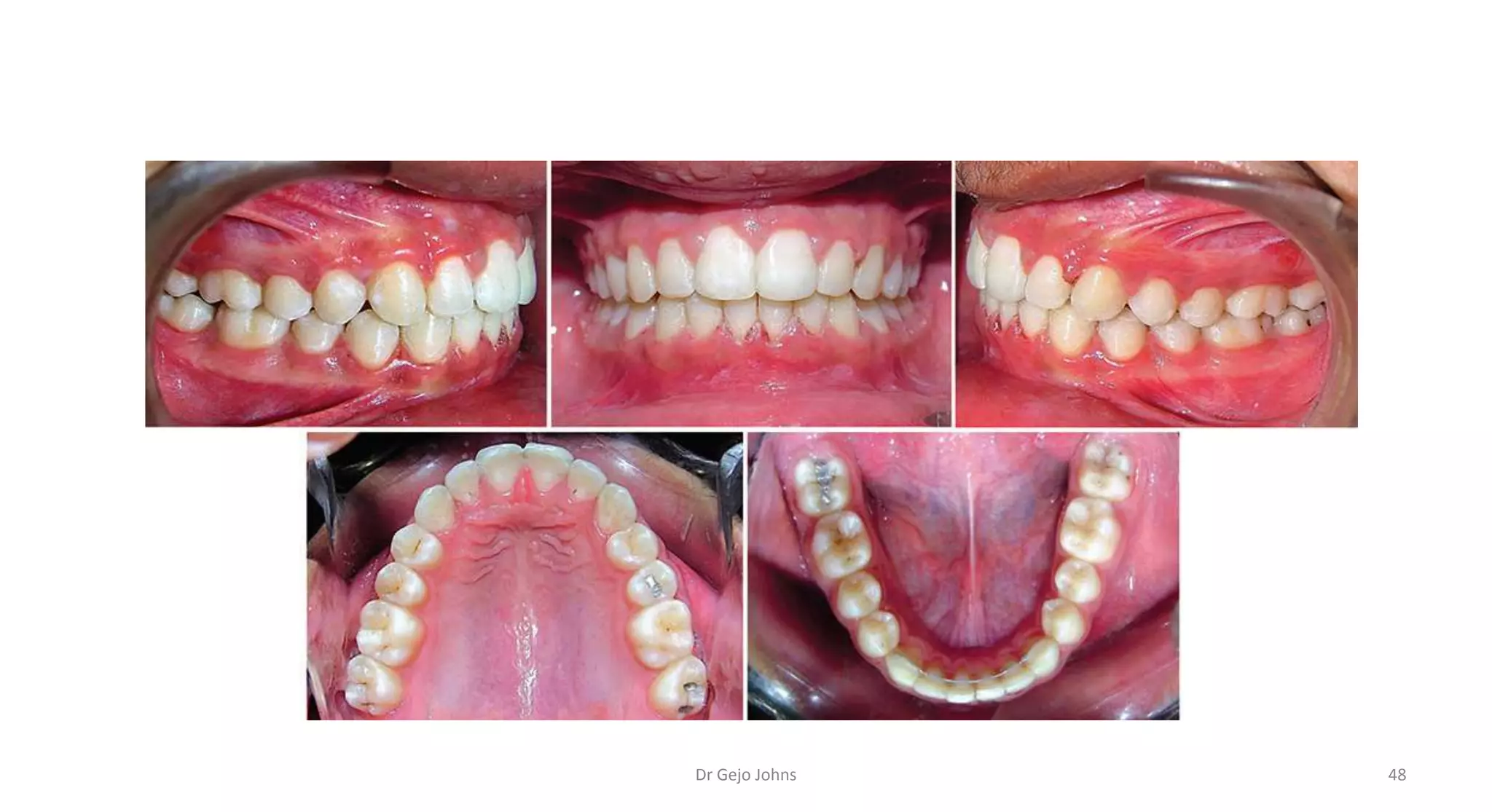 Infra-zygomatic Crest implants (IZC) | PPTX