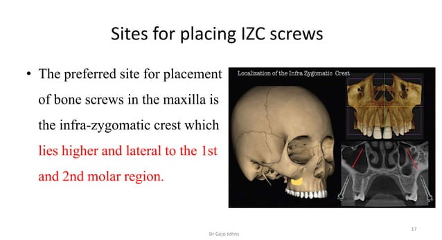 Infra-zygomatic Crest implants (IZC) | PPTX | Dental Health | Diseases ...