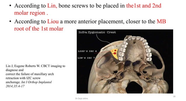 Infra-zygomatic Crest implants (IZC) | PPTX | Dental Health | Diseases ...