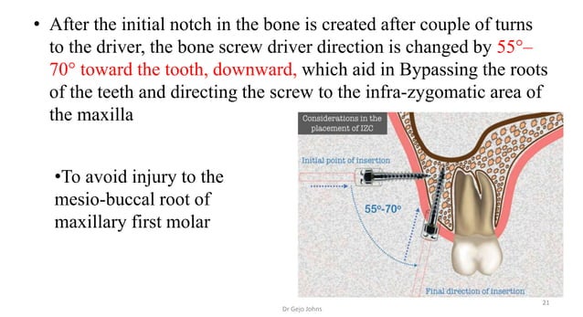 Infra-zygomatic Crest implants (IZC) | PPTX | Dental Health | Diseases ...