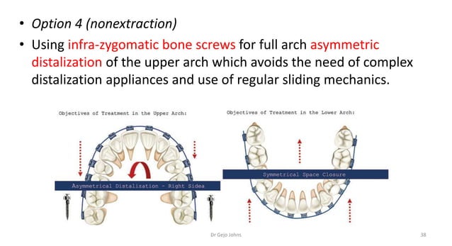 Infra-zygomatic Crest implants (IZC) | PPTX | Dental Health | Diseases ...