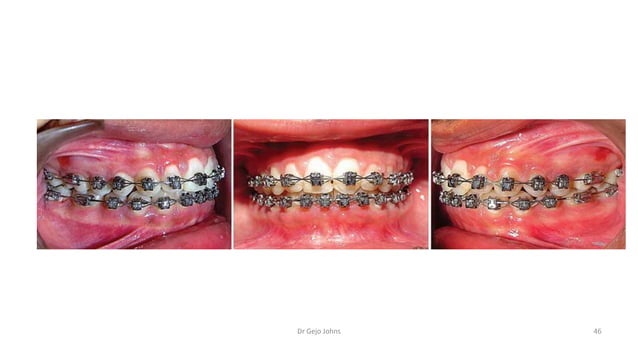 Infra-zygomatic Crest implants (IZC) | PPTX | Dental Health | Diseases ...
