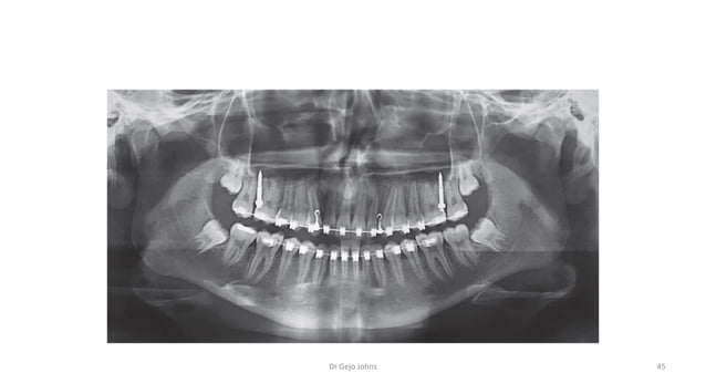 Infra-zygomatic Crest implants (IZC)