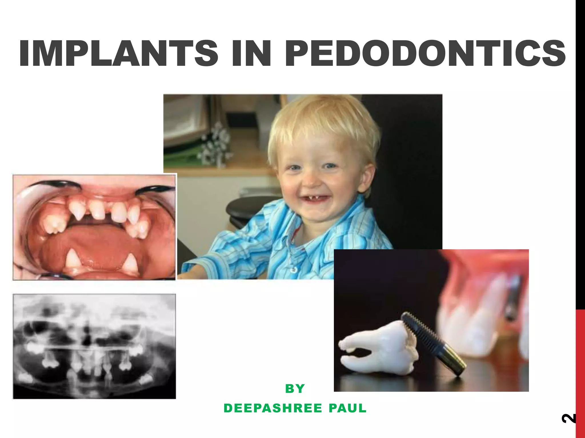 Implants in pedodontics | PPTX