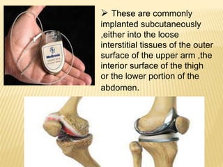 Implants & inserts ppt | PPTX