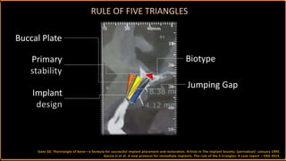 Implant Site Preparation.pptx