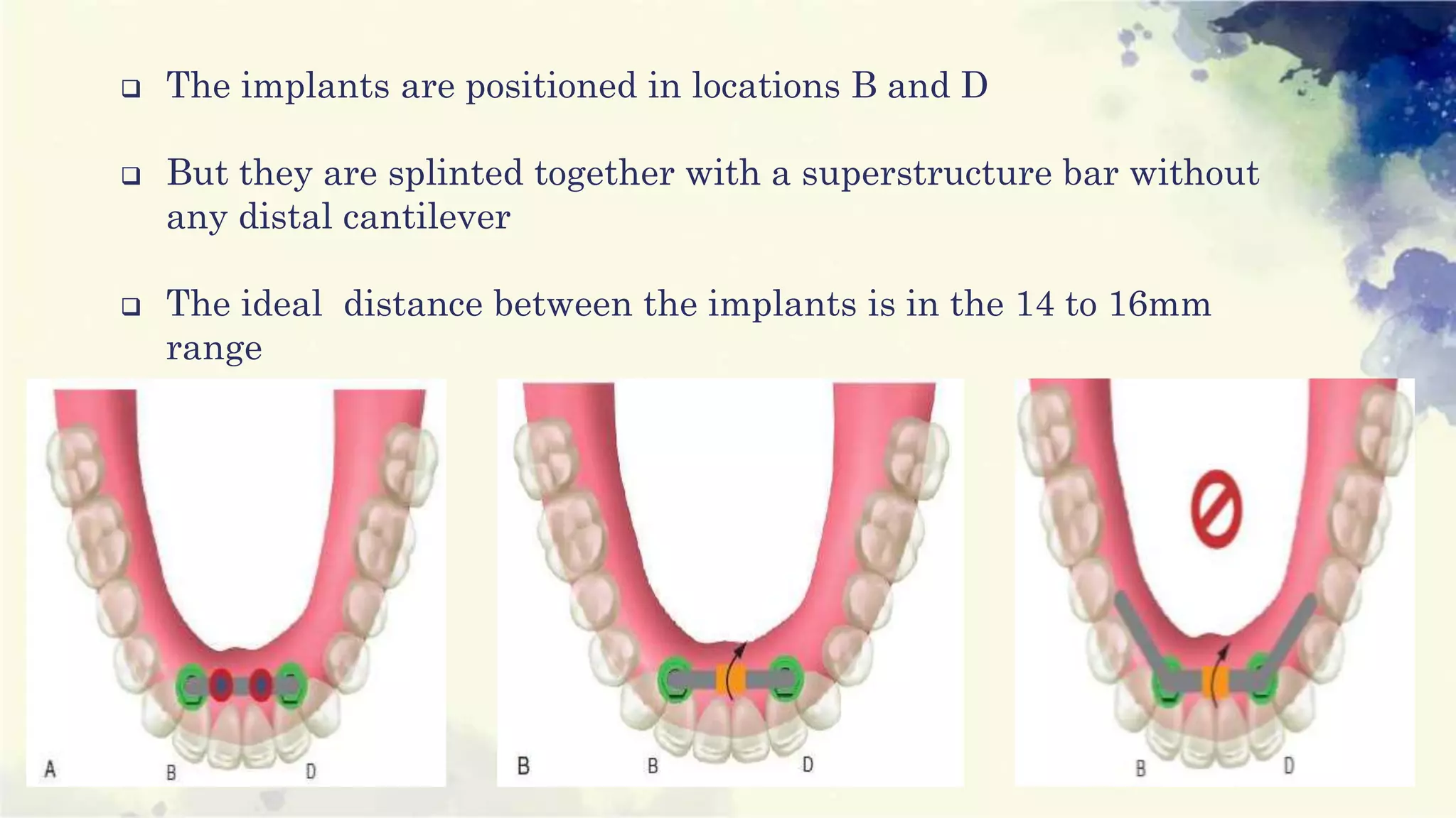 Implant supported overdenture | PPTX