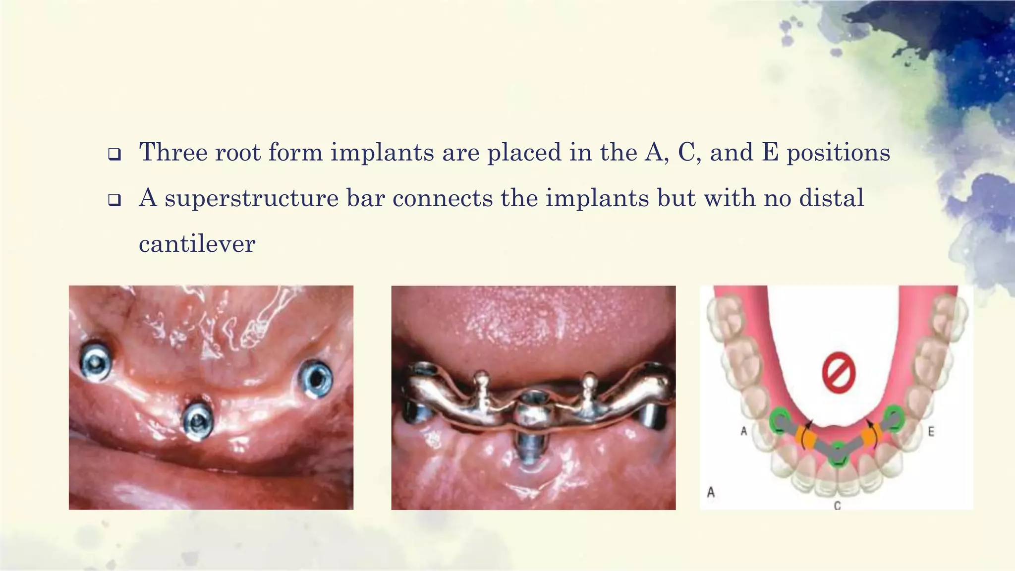 Implant supported overdenture | PPTX