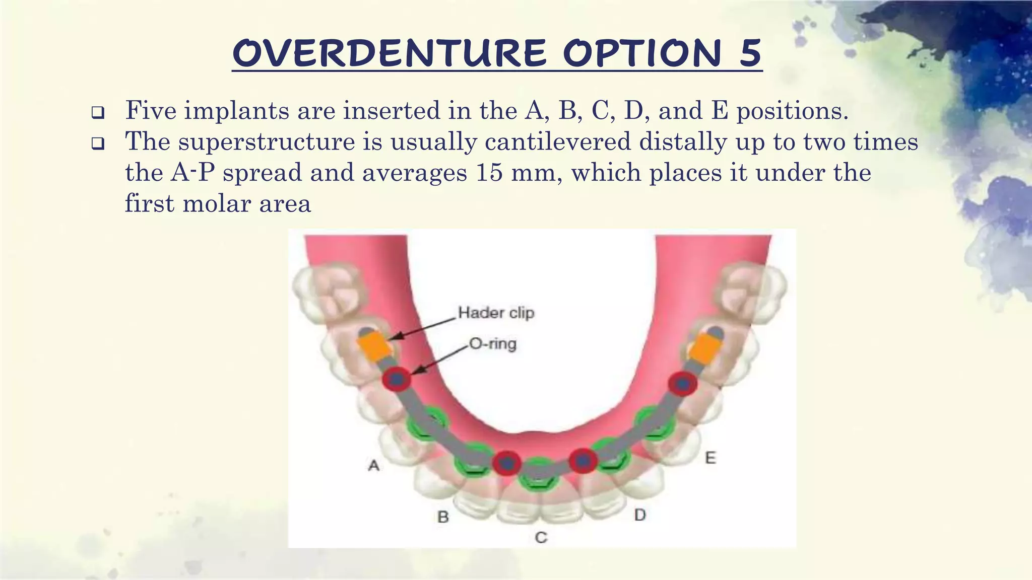 Implant supported overdenture | PPTX
