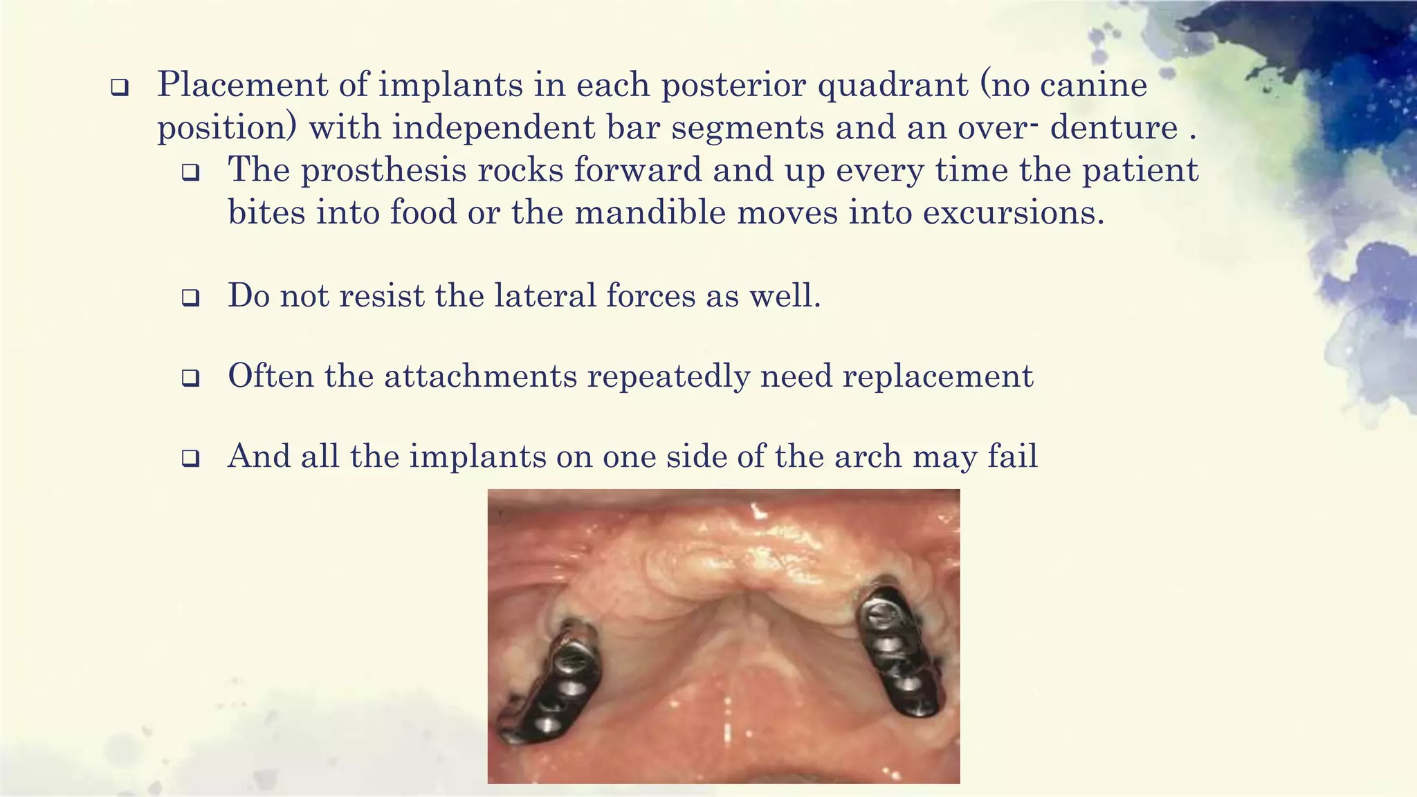 Implant supported overdenture | PPTX