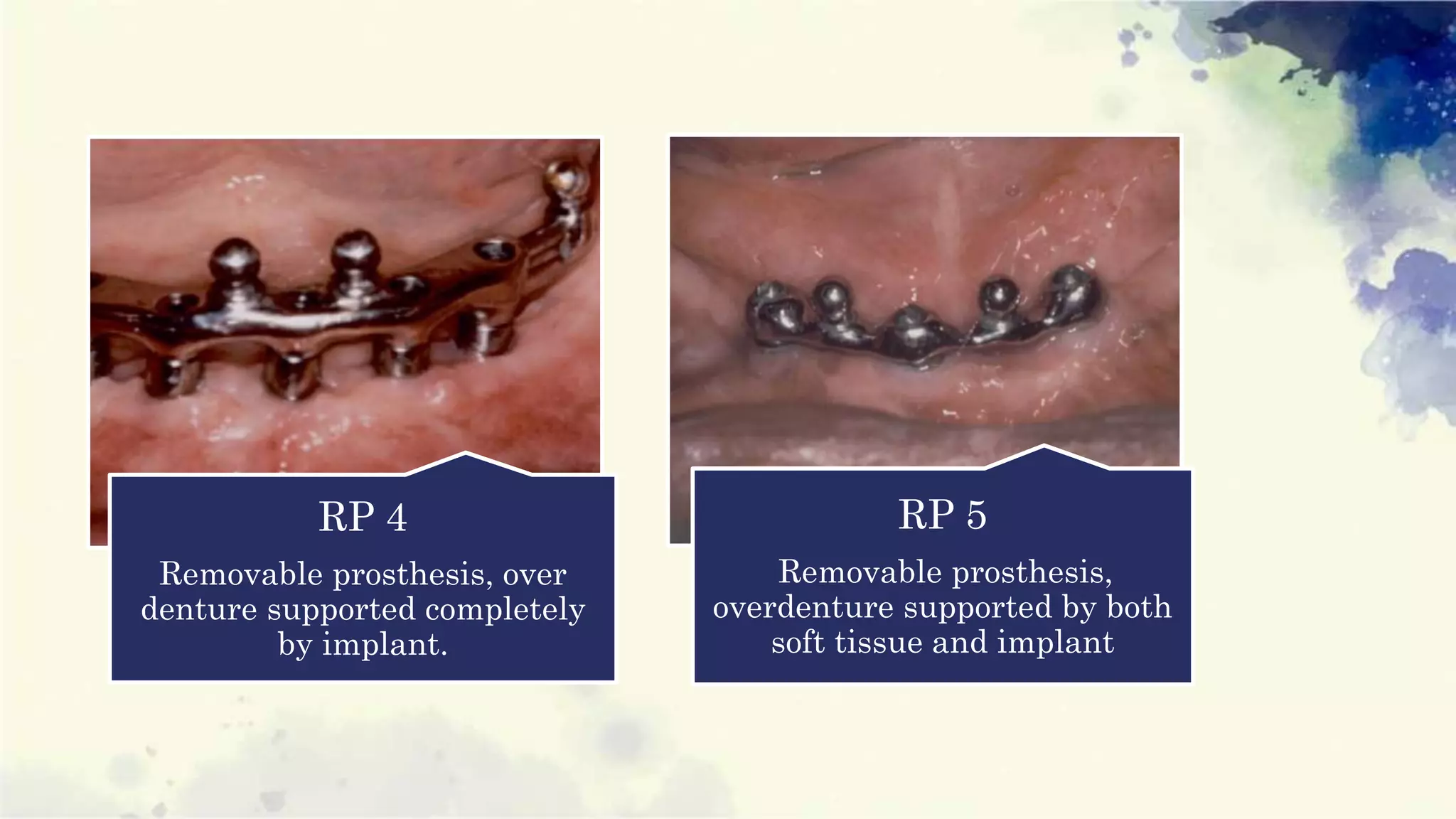 Implant supported overdenture | PPTX