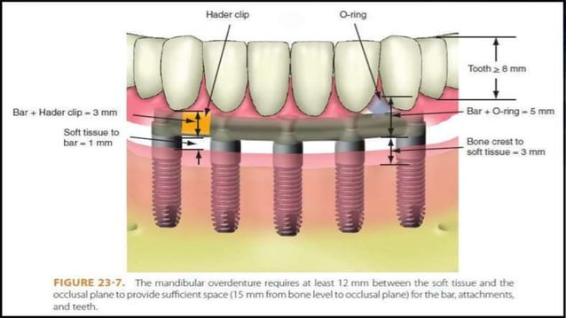 Implant supported overdenture | PPTX
