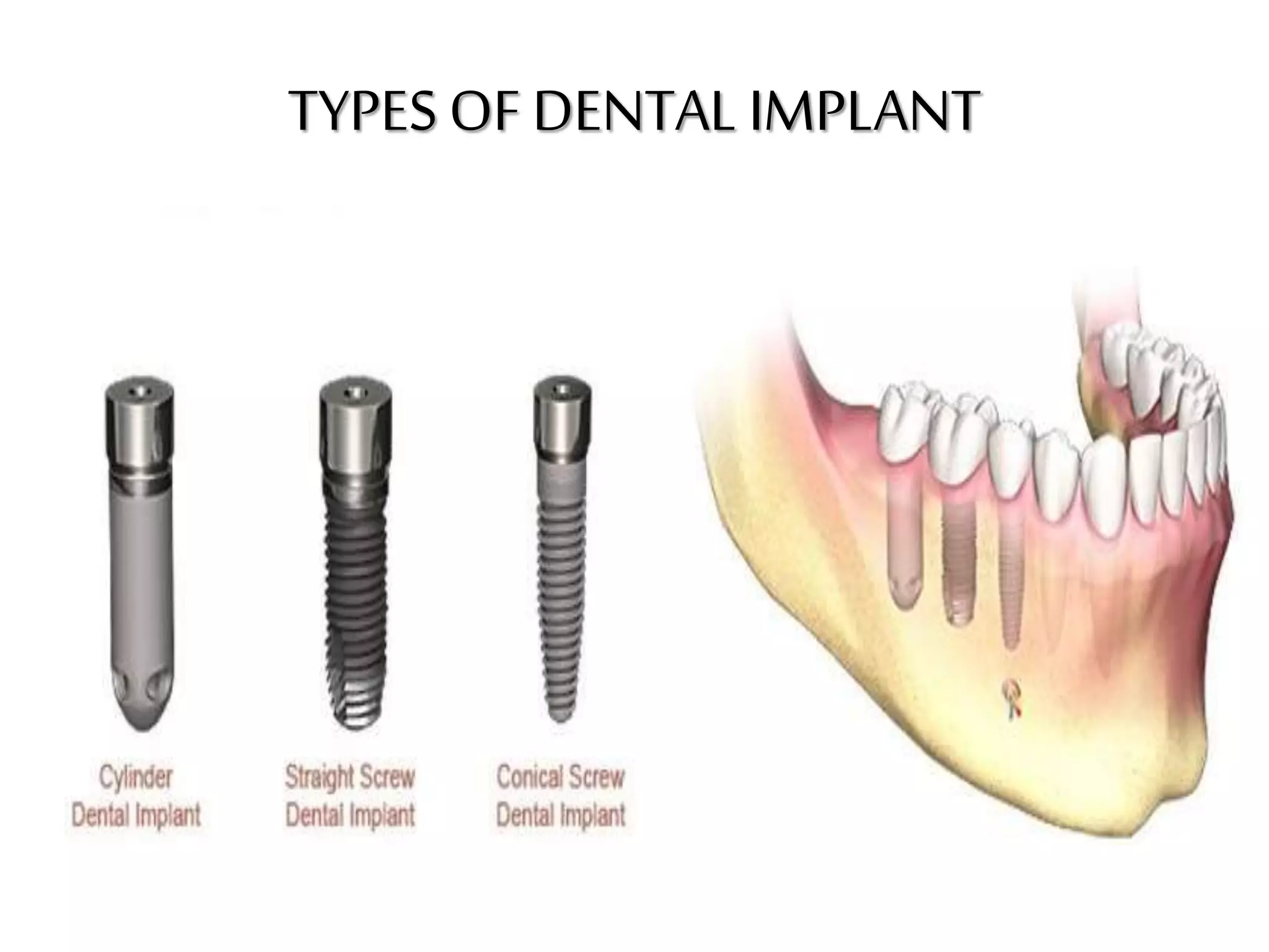 Implants (biomaterials) | PPT