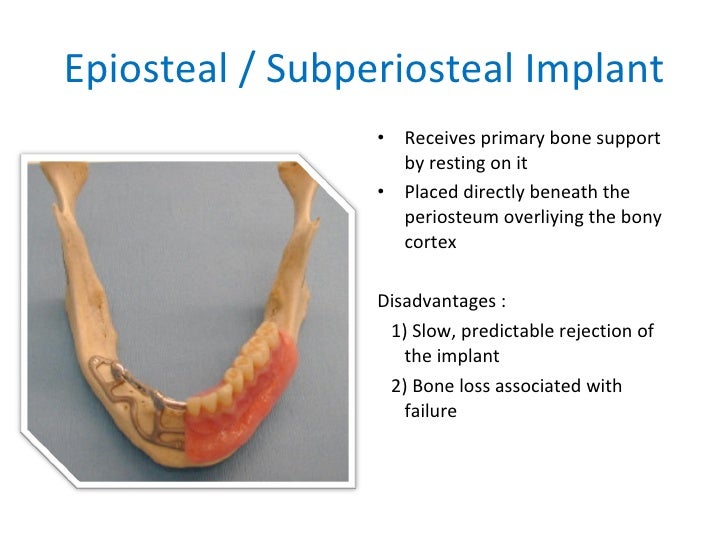 Implants the future of prosthodontics