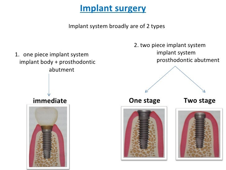 Implants the future of prosthodontics