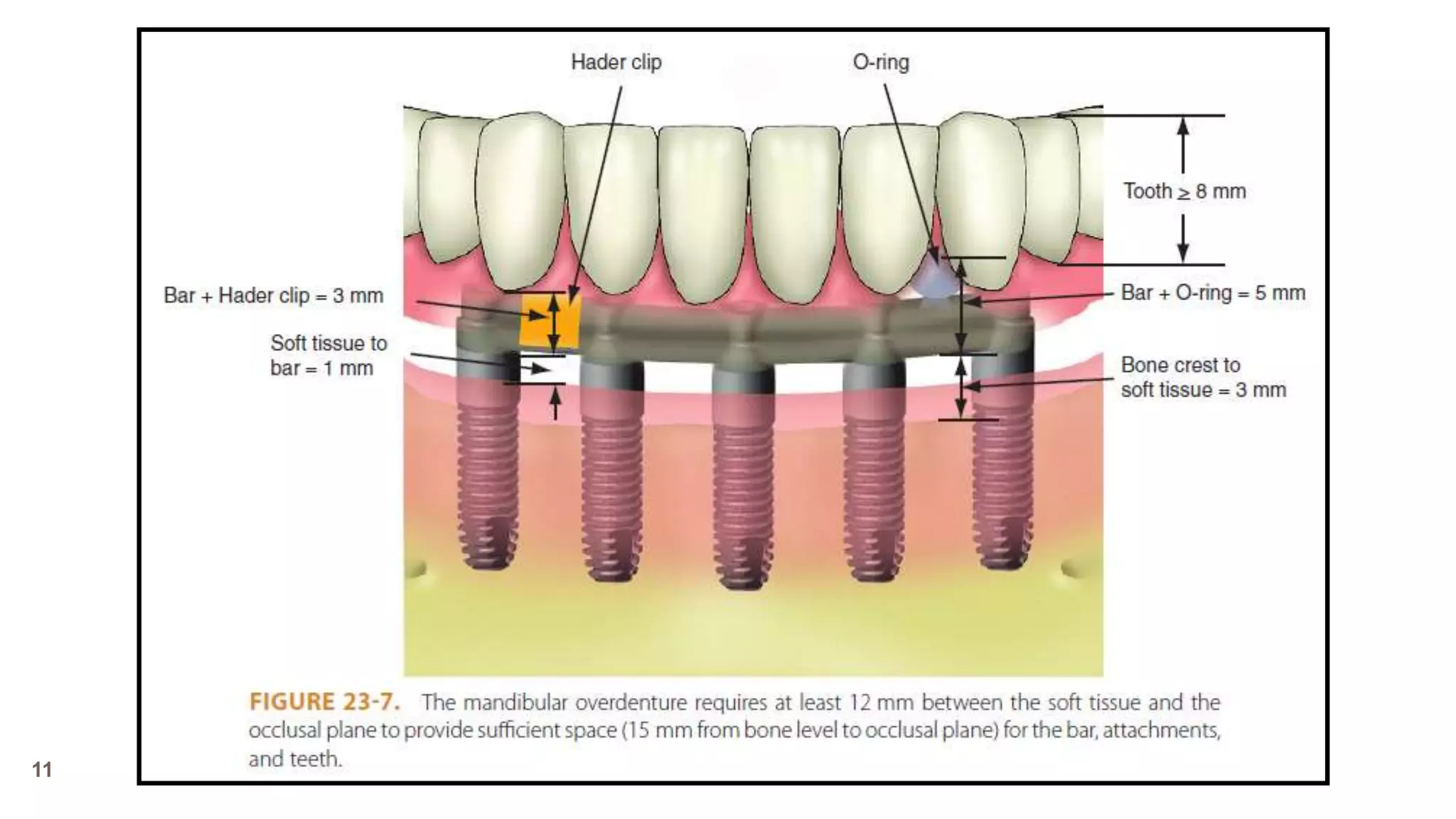 Implant supported overdenture | PPTX