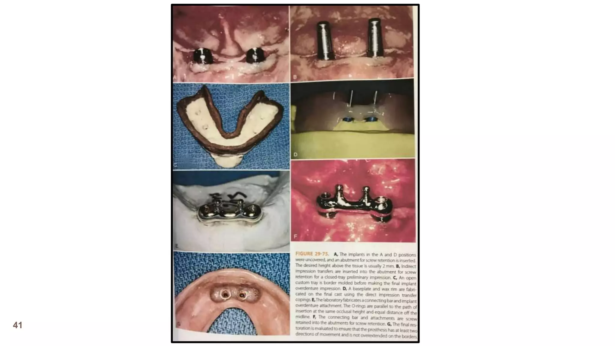 Implant supported overdenture | PPTX