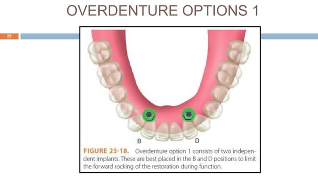 Implant supported overdenture | PPTX