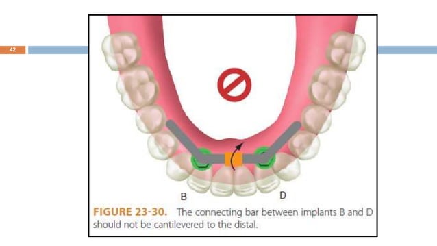 Implant supported overdenture | PPTX