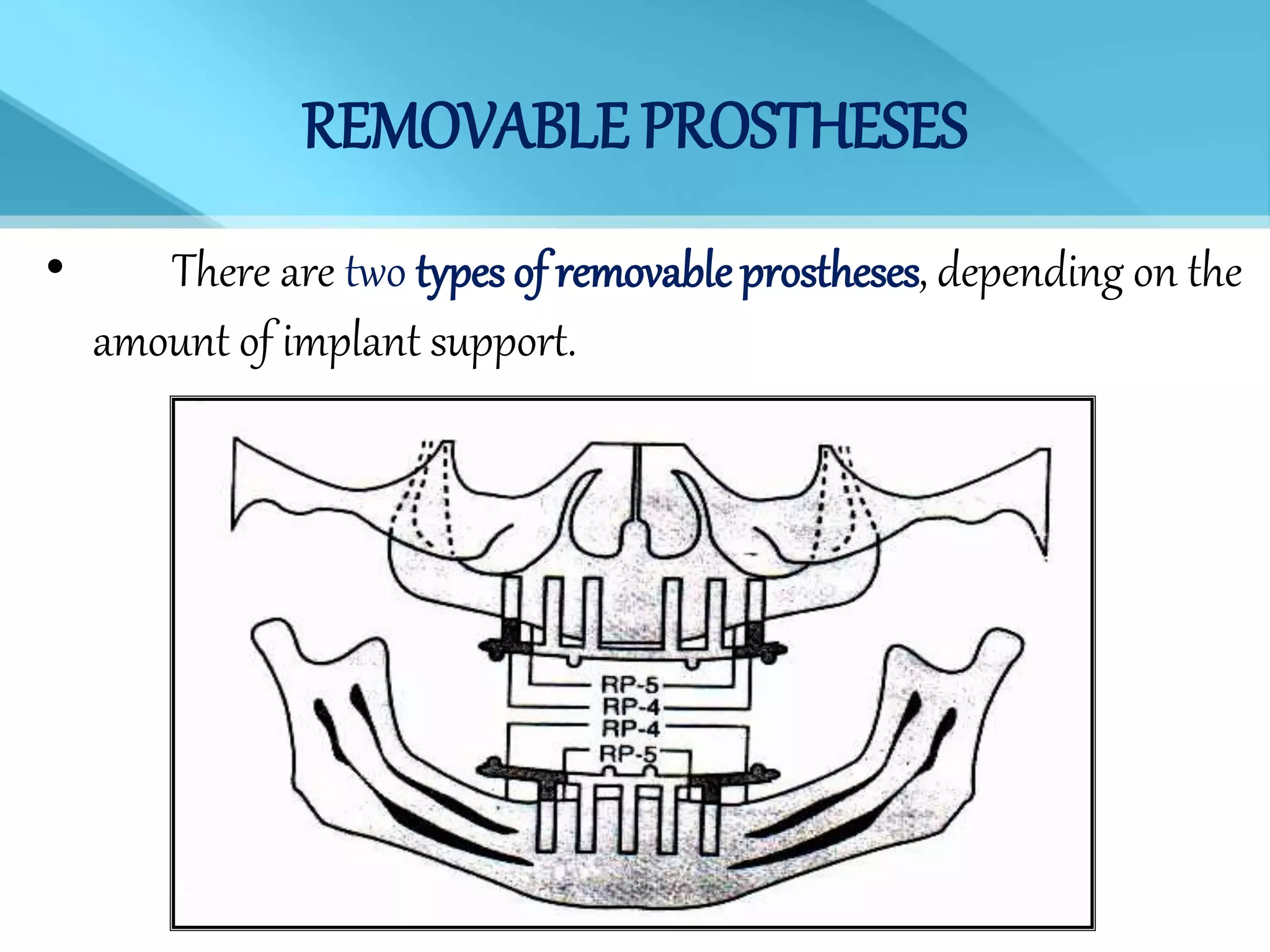 Implant supported overdentures | PPTX
